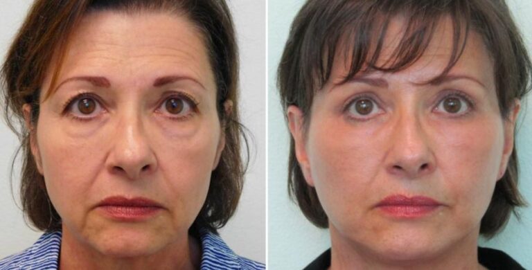 How Much Does a Lower Facelift Cost? | The Lafranchi Center