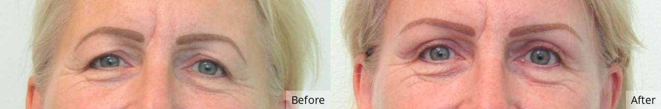 Can a Brow Lift Get Rid of Forehead Wrinkles? | Las Vegas & Nevada