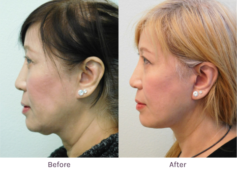 Neck Liposuction Las Vegas | Neck Lipo Henderson | The Lanfranchi Center