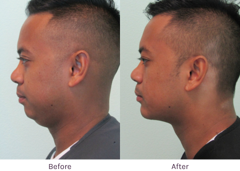 Neck Liposuction Las Vegas | Neck Lipo Henderson | The Lanfranchi Center