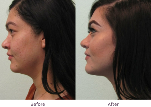 Neck Liposuction Las Vegas | Neck Lipo Henderson | The Lanfranchi Center