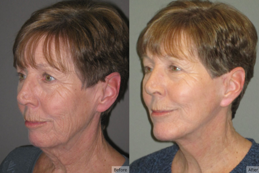 How Often Should I Have CO2 Laser Skin Rejuvenation? | Las Vegas & Nevada