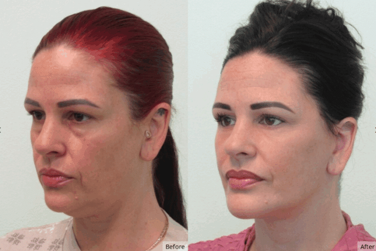 What Is a Local Anesthesia Facelift? Benefits, Recovery, and Who It’s ...