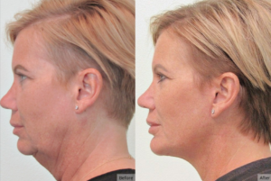Best Treatment for Neck Bands and Loose Skin: When Surgery Is the Right ...